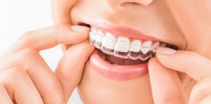 What Are Buttons in Invisalign? - Evolution Orthodontics | Blog